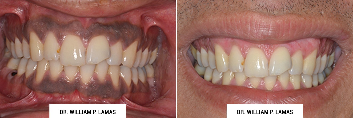 Dark Gum Depigmentation Before & After Photos - Dr. William Lamas