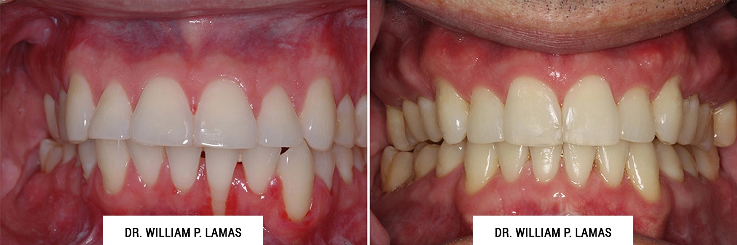 Gum Recession Treatment (Gum Grafting) Before & After Photos - Dr ...